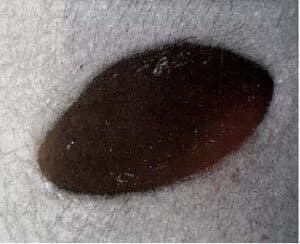 Knife Wounds: Understanding Patterns and Forensic Analysis