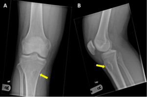 Types of Fractures