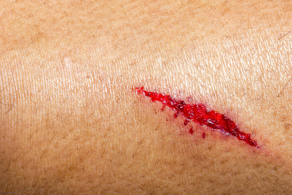 Knife Wound Forensic Analysis: Essential but Grim Reality